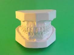 Diagnostic Cast/ Orthodontic Cast/Plaster Model – فرهنگ تفصیلی دندان پزشکی