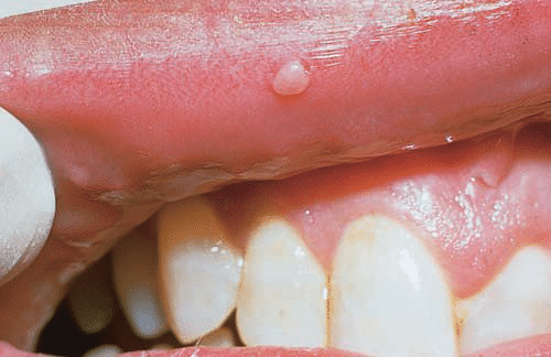 Papule – فرهنگ تفصیلی دندان پزشکی