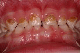 Rampant caries – فرهنگ تفصیلی دندان پزشکی