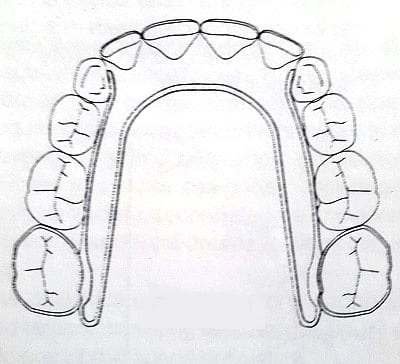 Porter Arch/W-Arch – فرهنگ تفصیلی دندان پزشکی