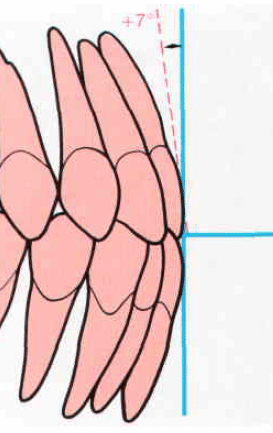 Crown Torque – فرهنگ تفصیلی دندان پزشکی