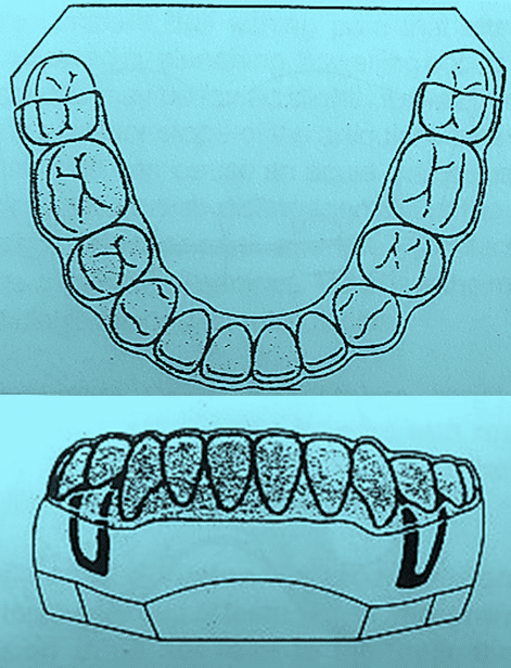 Vacuum-formed Retainer – فرهنگ تفصیلی دندان پزشکی