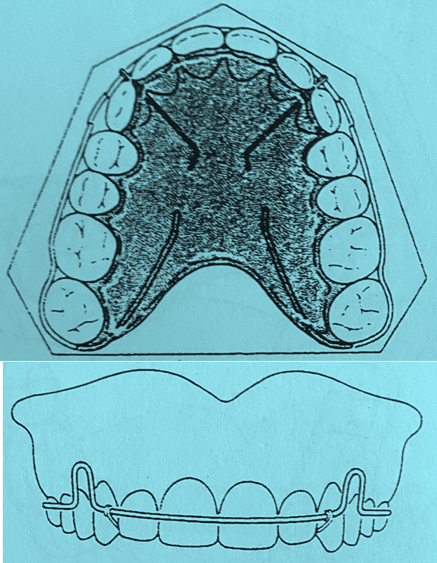 Wrap-around Retainer/ Circumferential Retainer – فرهنگ تفصیلی دندان پزشکی